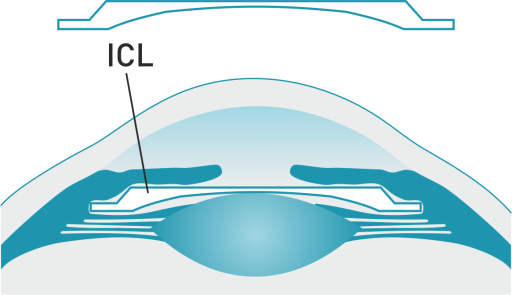 ICL artificial lens implantation ️ Vision improvement for thin corneas